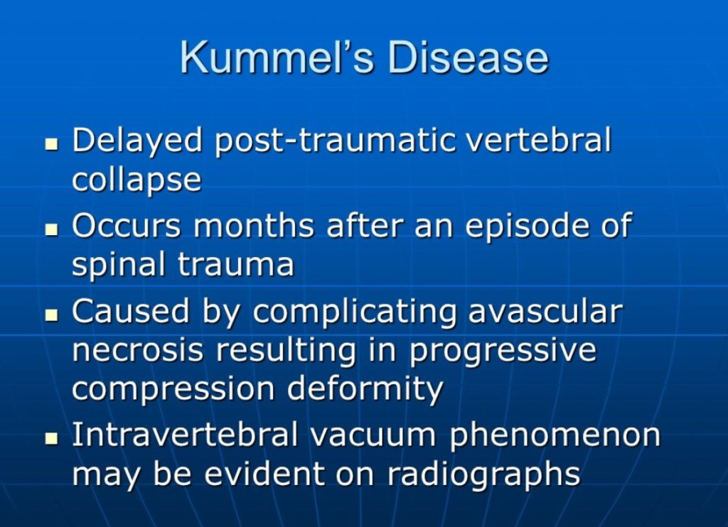 Kummel Disease – Avascular Necrosis-Osteonecrosis Education and Resources